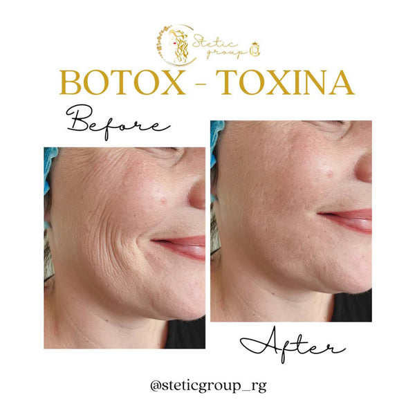 Botox – Stetic Group RG